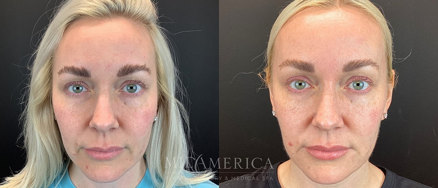 Jaw Filler Patient 351 before & afters | MidAmerica